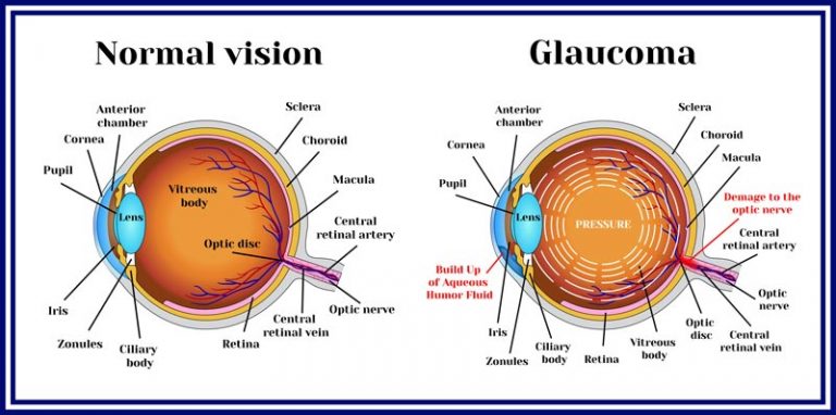 Glaucoma - Oneway Eyeglasses - Greenville, South Carolina