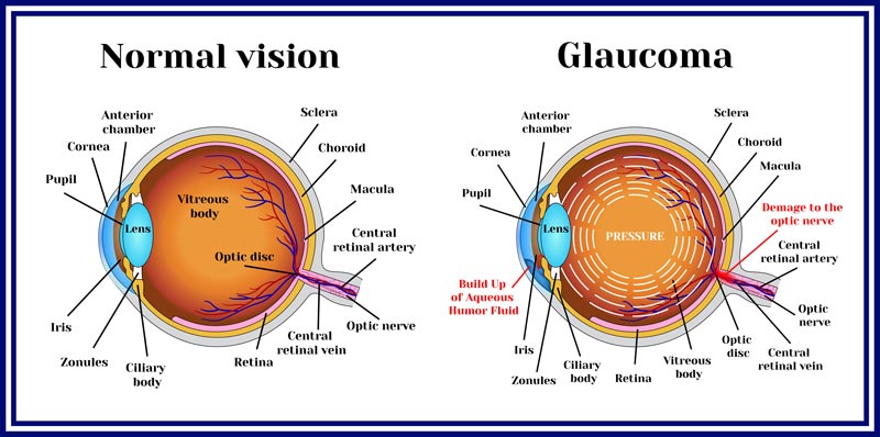 Glaucoma - Oneway Eyeglasses - Greenville, South Carolina